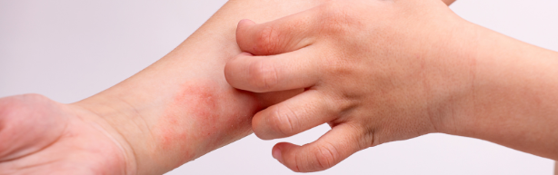 Dermatite atopique : causes, symptômes, prise en charge et traitement ...