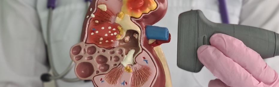 Comprendre les différents stades de l'insuffisance rénale chronique ...